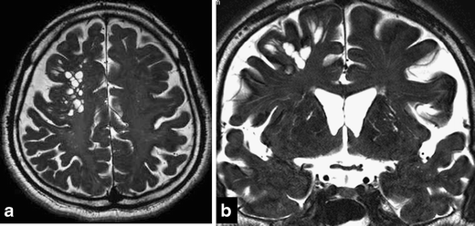 The Virchow-Robin spaces: delineation by magnetic resonance imaging ...
