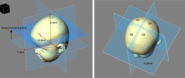 Three-dimensional analysis of positional plagiocephaly before and after ...