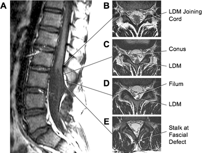 Limited dorsal myeloschisis: a not-so-rare form of primary neurulation ...