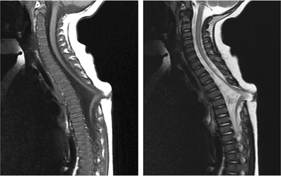 Limited dorsal myeloschisis: a not-so-rare form of primary neurulation ...