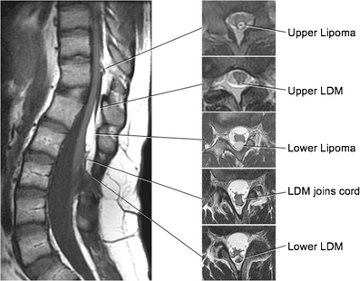 Limited dorsal myeloschisis: a not-so-rare form of primary neurulation ...