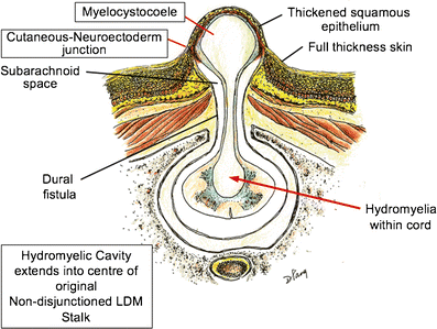 Limited dorsal myeloschisis: a not-so-rare form of primary neurulation ...