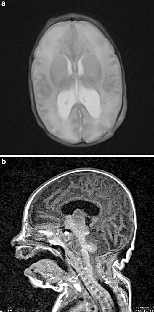 Cloacal exstrophy with extensive Chiari II malformation: case report ...