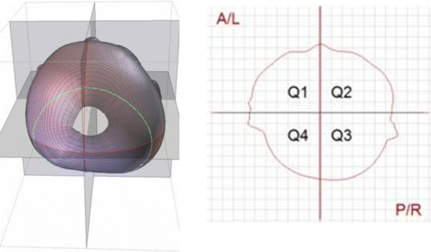 Cranial molding helmet therapy and establishment of practical criteria ...