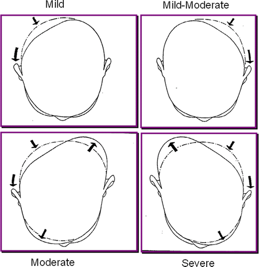Cranial molding helmet therapy and establishment of practical criteria ...