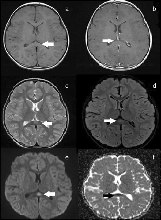 Transient lesion in the splenium of the corpus callosum due to ...