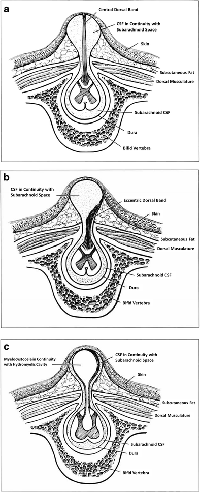 A practical clinical classification of spinal neural tube defects ...