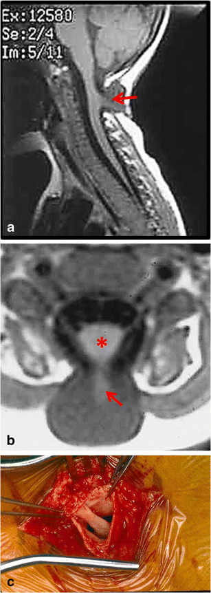 A practical clinical classification of spinal neural tube defects ...