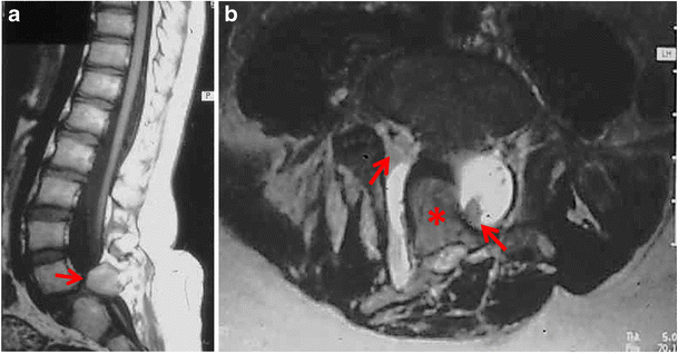 A practical clinical classification of spinal neural tube defects ...