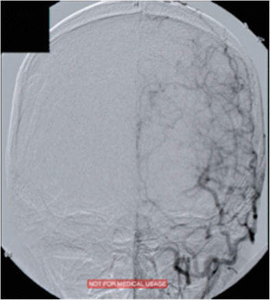 Bilateral encephaloduroarteriosynangiosis (EDAS) in a 6-year-old female ...