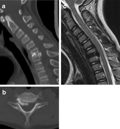 Cervical intervertebral disc calcification with extreme lateral ...