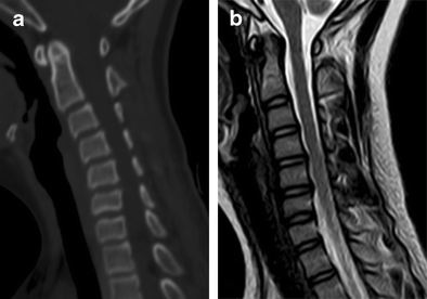 Cervical intervertebral disc calcification with extreme lateral ...