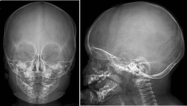 Diagnostic features of prematurely fused cranial sutures on plain skull ...