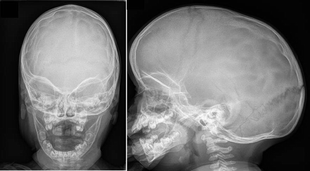 Diagnostic features of prematurely fused cranial sutures on plain skull ...