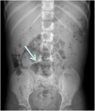 Lumbar ribs: a comprehensive review | SpringerLink