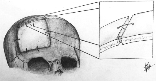 Craniotomy bone flap fixation: revisiting the use of bone struts ...