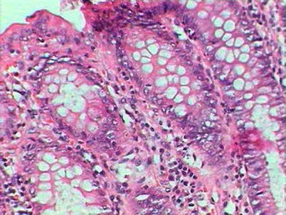 Diphallus with ectopic bowel segment: a case report | SpringerLink