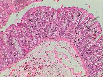 Diphallus with ectopic bowel segment: a case report | SpringerLink