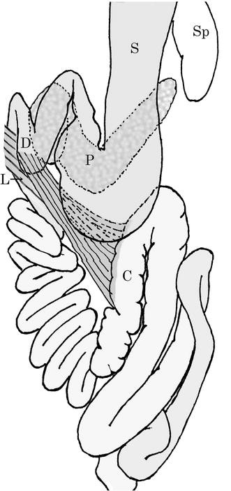 Recurrent acute pancreatitis caused by malrotation of the intestine and ...