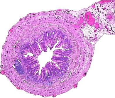 A neonate with an intact congenital umbilical appendix: an alternative ...