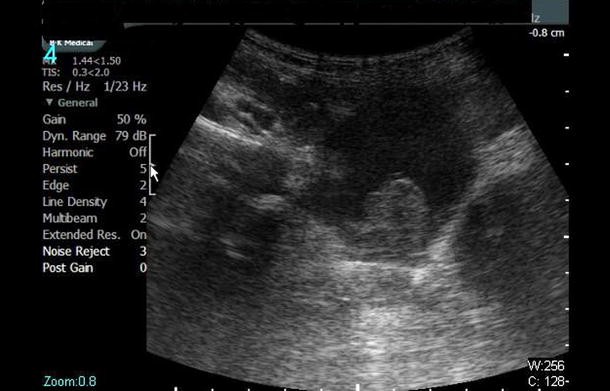 Fibroepithelial polyp of the bladder neck in children | SpringerLink