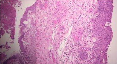 Fibroepithelial polyp of the bladder neck in children | SpringerLink