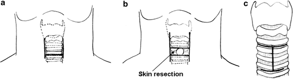 Laryngotracheal separation using skin flap formation: a novel surgical ...
