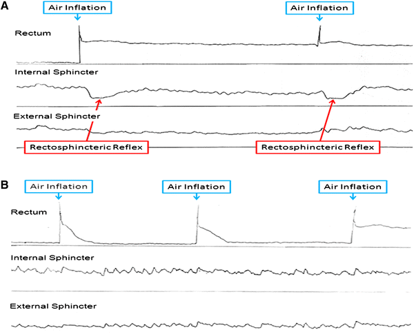 Comparison of posterior internal anal sphincter myectomy and ...