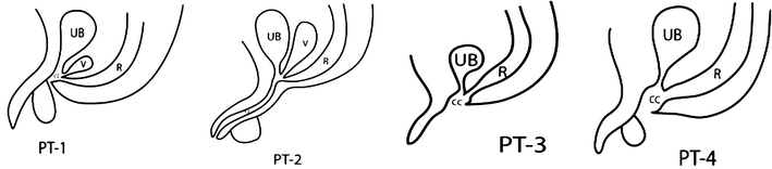 Cloacal malformation variants in male | SpringerLink