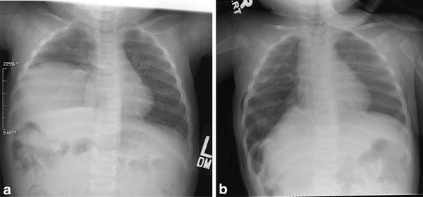A simple thoracoscopic plication technique for diaphragmatic ...