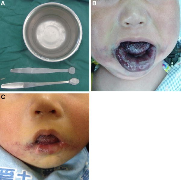 Liquid nitrogen cryotherapy for lip mucous membrane venous malformation ...