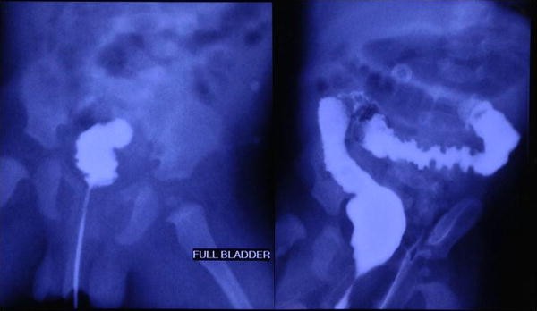 Male cloaca malformation: rare variant of anorectal malformation ...