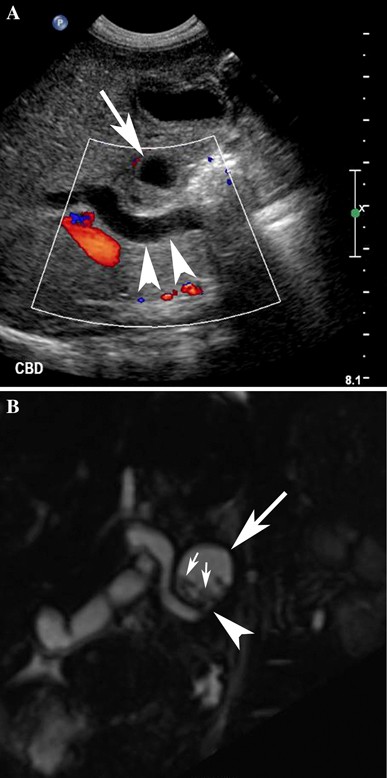Pediatric choledochal cysts: diagnosis and current management | SpringerLink
