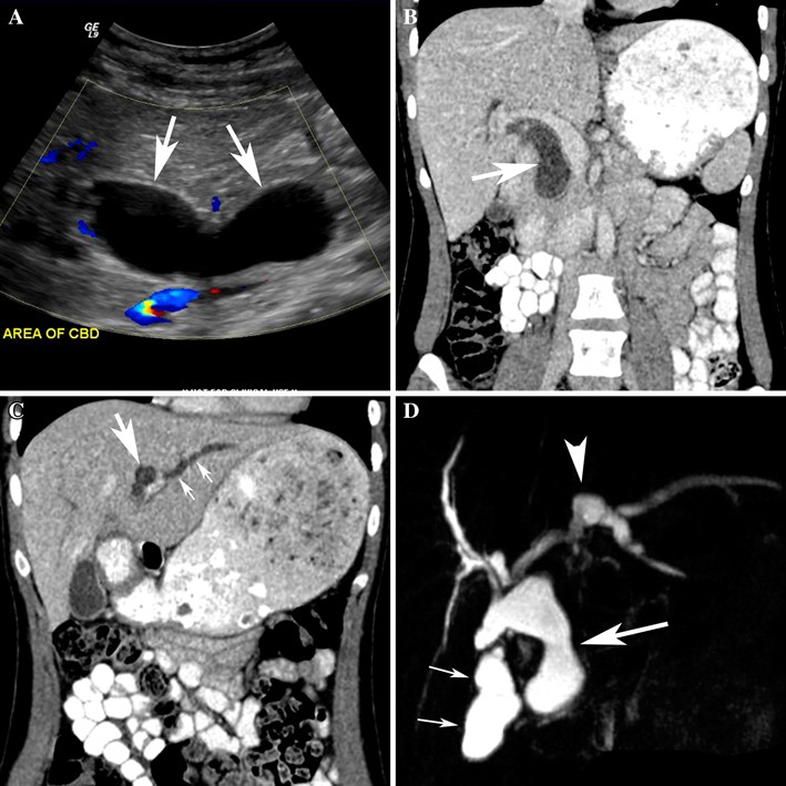 Pediatric choledochal cysts: diagnosis and current management ...