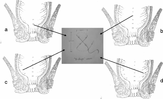 A modified Delorme’s operation for the treatment of rectal mucosal ...