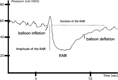 Modulation of the rectoanal inhibitory reflex (RAIR): qualitative and ...