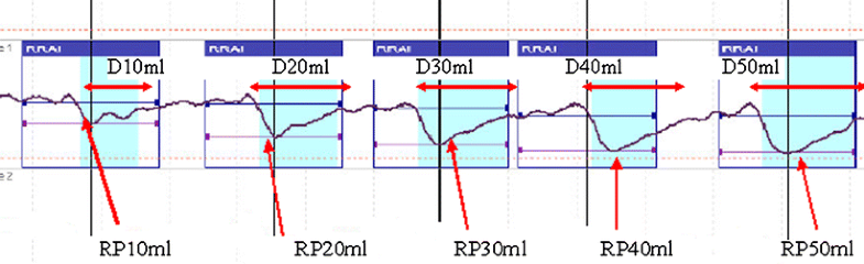 Modulation of the rectoanal inhibitory reflex (RAIR): qualitative and ...