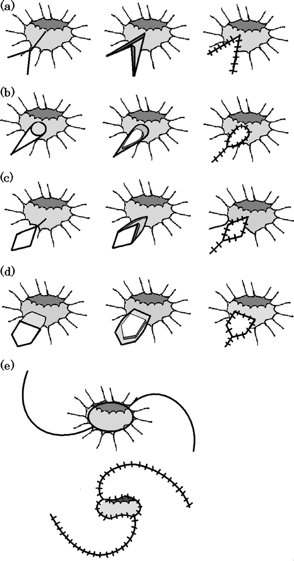 New application of the gluteal-fold flap for the treatment of anorectal ...
