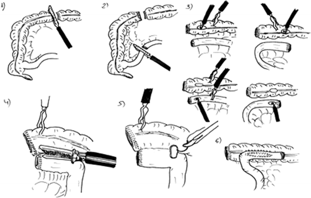 Isoperistaltic versus antiperistaltic side-to-side anastomosis after ...