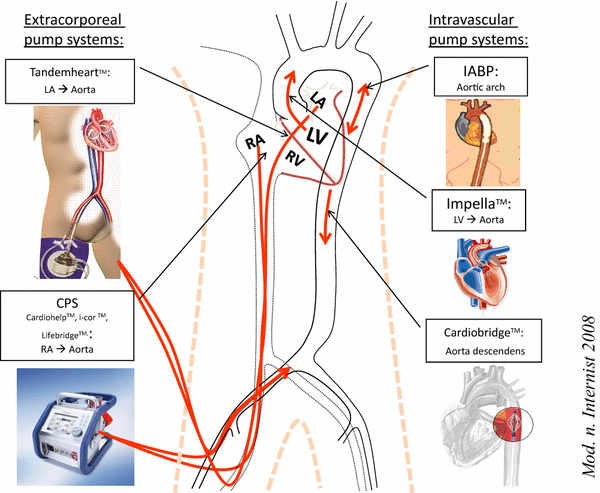An insight into short- and long-term mechanical circulatory support systems | SpringerLink