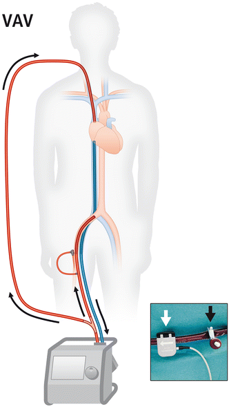 Cannulation strategies for percutaneous extracorporeal membrane ...