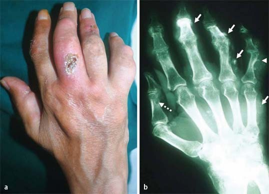 Neue Aspekte zur Pathogenese der Gicht | SpringerLink