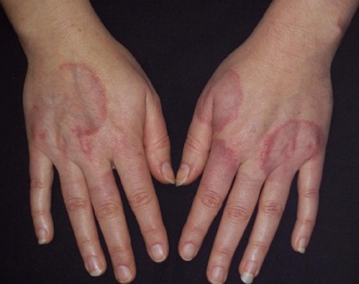 Dermatologische Krankheitsbilder in der Rheumatologie | SpringerLink