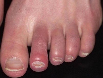 Dermatologische Krankheitsbilder in der Rheumatologie | SpringerLink