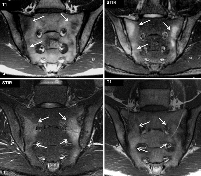 MRT-Untersuchungen bei axialer und peripherer Spondyloarthritis ...