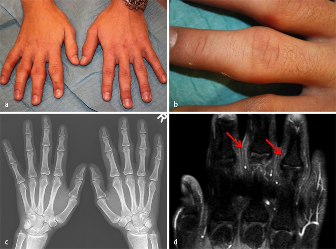 Pachydermodaktylie | SpringerLink