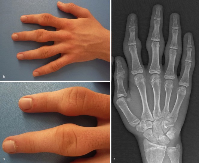 Pachydermodaktylie | SpringerLink