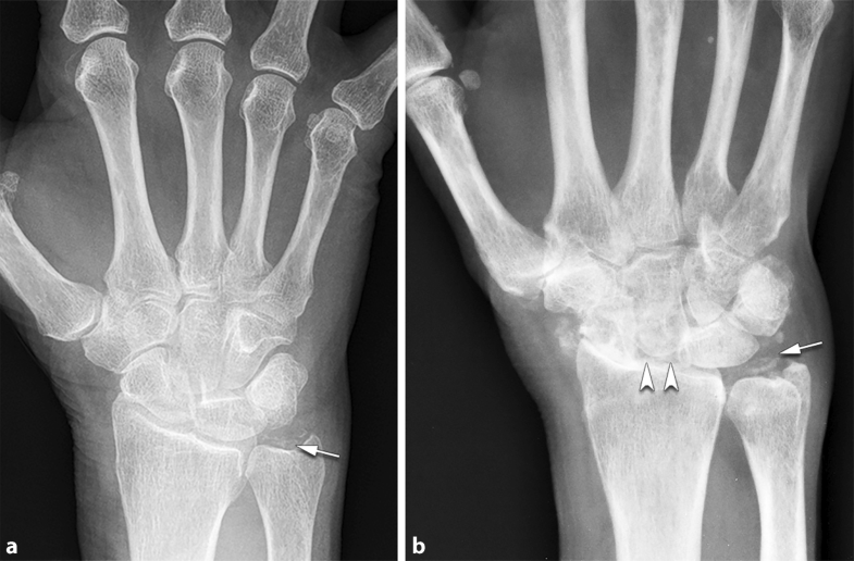 Rheumatoide Arthritis – Mimics | SpringerLink