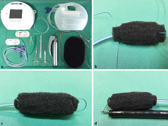 Endoskopische Vakuumtherapie bei Ösophagusläsionen | SpringerLink