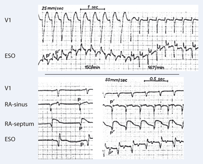 Concealed accessory pathways | SpringerLink